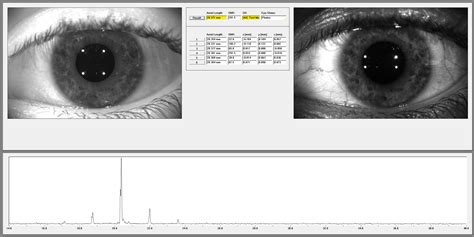 Ocular Biometry — Ophthalmic Clinical Trials
