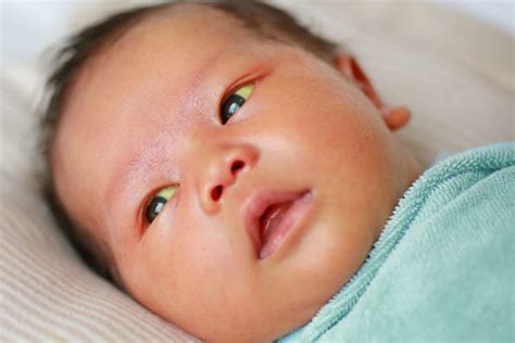 Icterícia neonatal O que é causas diagnóstico tratamento e cuidados