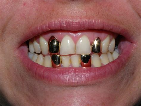 Tooth Replacement Options All You Need To Know Forest Ray