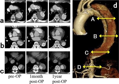 Three Dimensional Cta Reconstruction Demonstrated Type B Dissection A