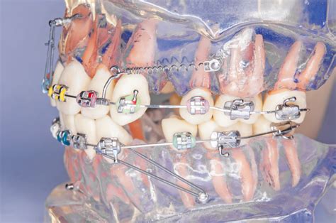 microimplantes ortodoncia en La Rioja archivos Clínica Dental Valvanera
