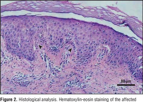 Figure 2 From Iga Anti P200 Pemphigoid Semantic Scholar