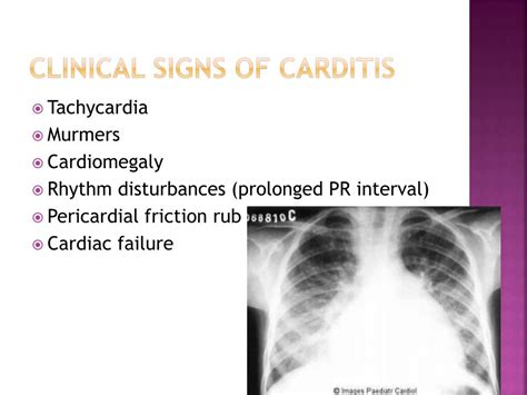 Ppt Acute Rheumatic Fever And Rheumatic Heart Disease Powerpoint