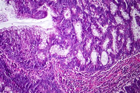 Microscopio A Luce Di Adenocarcinoma Colon Fotografia Stock Immagine Di Patologico Diagnosi