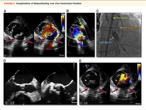 Figure 1 From Echocardiographic Imaging Of Procedural Complications