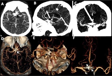 Figure 1 From The Utility Of Dual Energy Computed Tomography