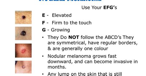 Mission Melanoma Nodular Melanoma