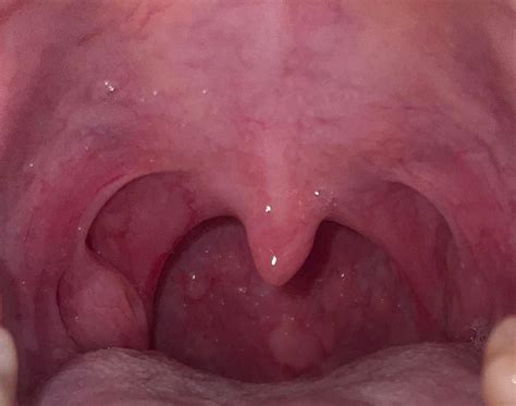 Right Tonsil Swollen For Almost A Month Rmedical