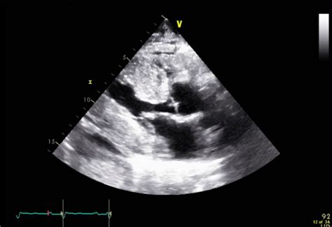 A Case Of Cardiac Amyloidosis With Left Ventricular Outflow Obstruction With Significant