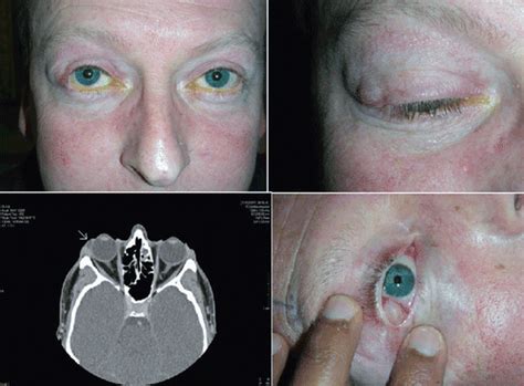 Lateral Canthus Cyst Peri Ocular Dermatology