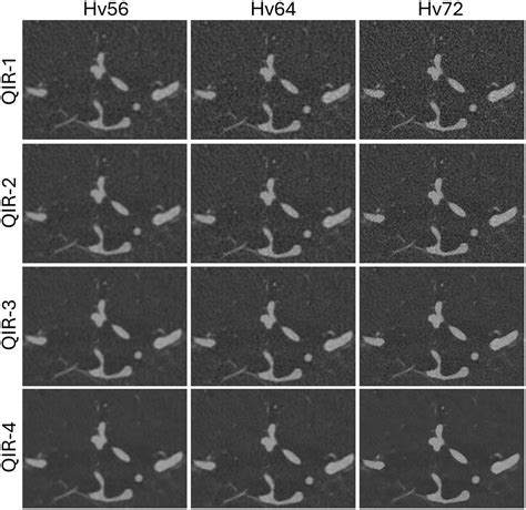 Advancing Neurovascular Imaging Optimization Of Reconstruction Kernel