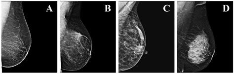 Tomography Free Full Text A Review Of Computer Aided Breast Cancer