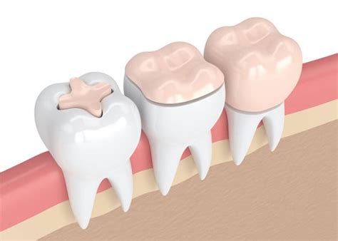 Fillings Vs Crowns Which One Do You Need Dentist For Life