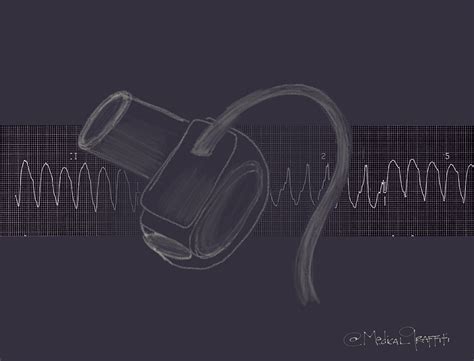 Lvad Troubleshooting Low Flow And Power Drops University Of Maryland