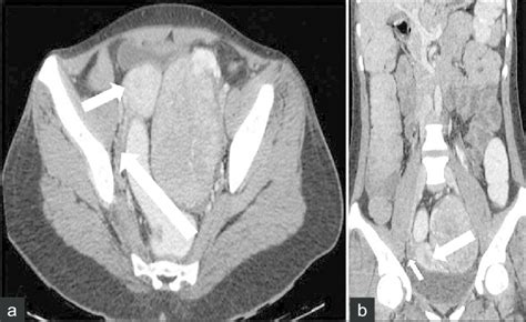 A 21 Year Old Female With Left Ovarian Sertoli Leydig Cell Tumor On