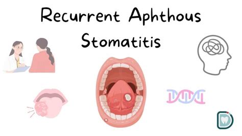 Zara Hayat On Linkedin Understanding Recurrent Aphthous Stomatitis