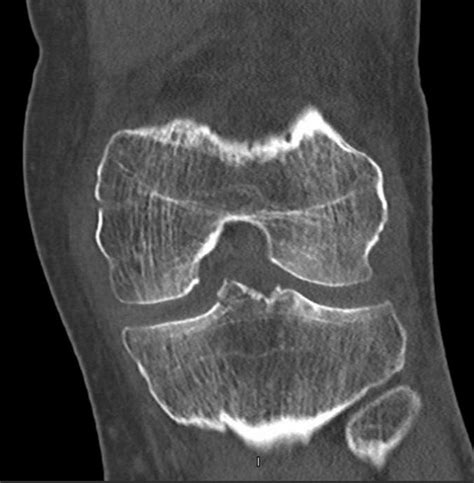 Tibial Intercondylar Eminence