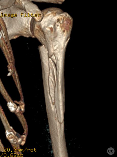 Anterolateral Helix Plate Segmental Proximal Humerus Fracture