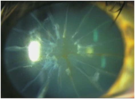 Refractive Surgery Mt 1 History Of Refractive Procedures Flashcards