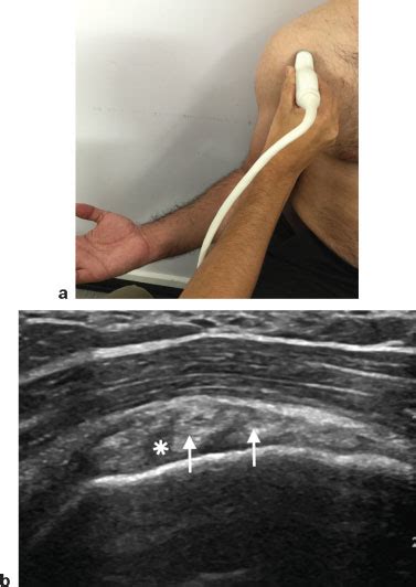 Subscapularis Tendon Short Axis A Transducer Placement Over The Download Scientific