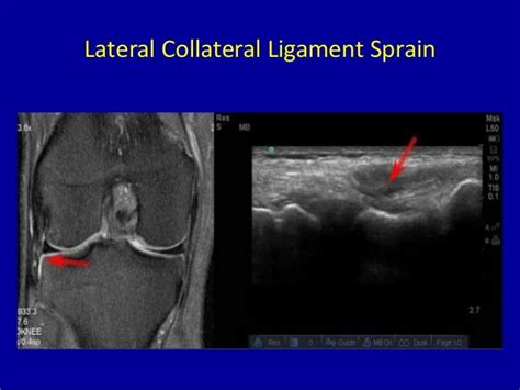 Imaging Of Knee By Mr And Usg