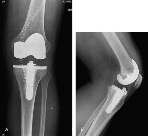 Removal Of A Well Fixed Trabecular Metal Monoblock Tibial Component