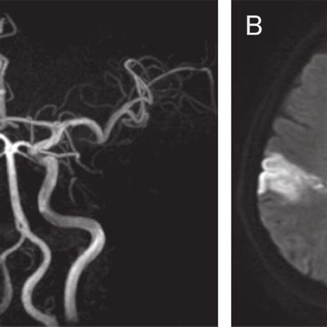 Mri And Mra Of The Brain At The Time Of Onset A On The Mra Signal