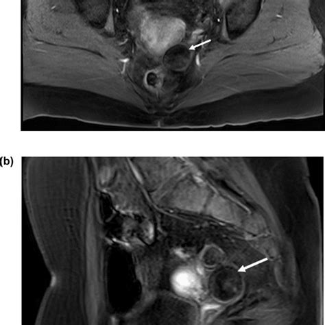 Axial A And Sagittal B 3d Volumetric Gradient Echo Sequence Post