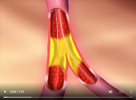 A Step By Step Description Of The Dk Crush Technique Cardiac Interventions Today