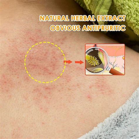 Hair Follicle Cream Treat Folliculitis Skin Inflammation Antibacterial