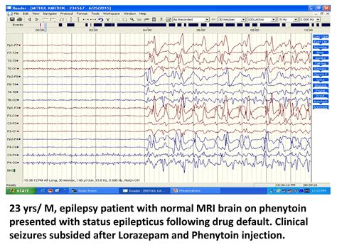Pediatric Status Epilepticus PPTX