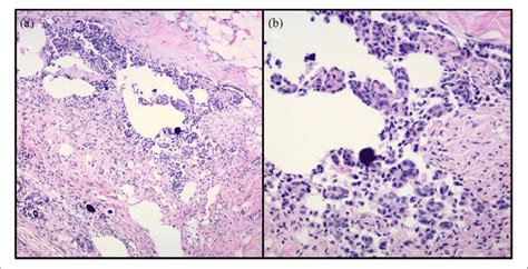 Hematoxylin Eosin Stain Demonstrating Histological Features Of Low
