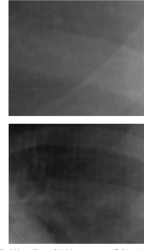 figure 1 from grid artifacts suppression in computed radiographic