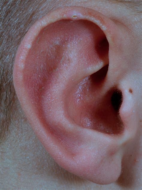 Chondrodermatitis Nodularis Helicis