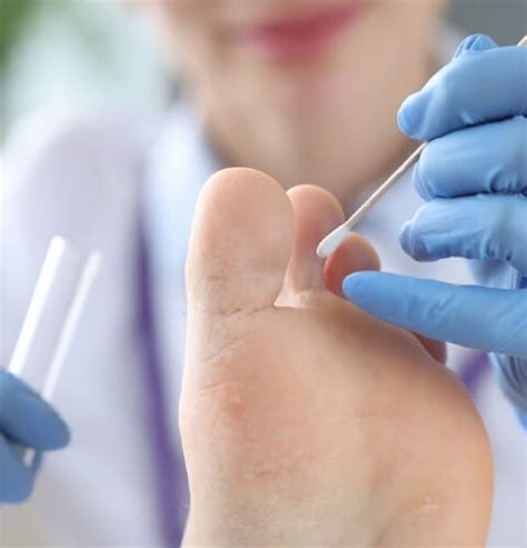 Fungal Nails Royal Podiatry