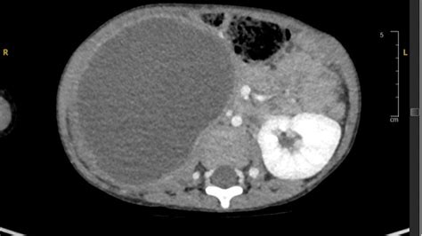 Multidisciplinary Team Provides Specialized Care For 3 Year Old With