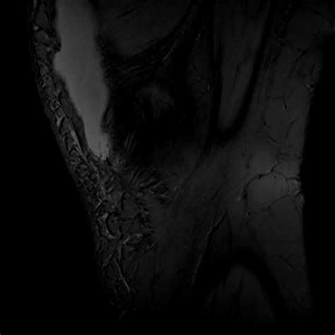 Osteochondritis Dissecans Ocd And Grade I Chondromalacia Patella