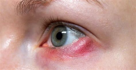 Protect Your Vision From These Common Eye Infections
