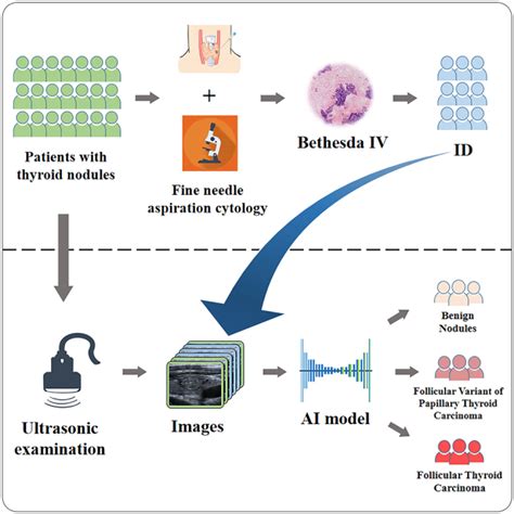 Ai Diagnosis Of Bethesda Category Iv Thyroid Nodules Pmc