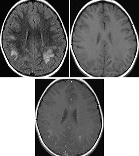 Acute Disseminated Encephalomyelitis The Neurosurgical Atlas