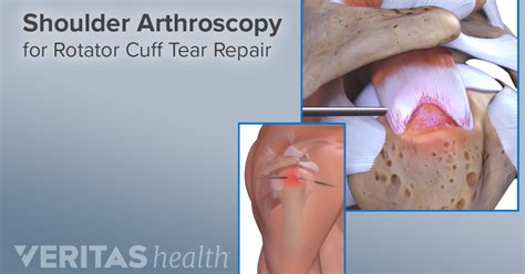 Rotator Cuff Repair Surgery