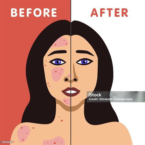 여드름 피부 치료 전과 후 공정한 여자의 벡터 이미지 미니멀리즘 그림 몸매 관심에 대한 스톡 벡터 아트 및 기타 이미지 몸매 관심 사람 얼굴 개념 Istock
