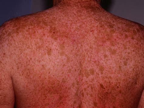 Age Spots Causes How To Get Rid Cream And Treatment