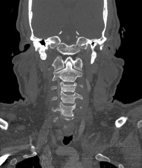 Stylohyoid Syndrome Pacs