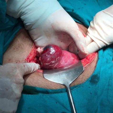 Shows Ultrasound Findings Of Cervical Ectopic Pregnancy Download Scientific Diagram