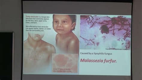 Mycology Dermatophytids And Its Clinical Significance Mbbs Class Youtube