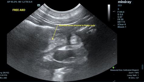 Going On An Ultrasound Foreign Body Hunt