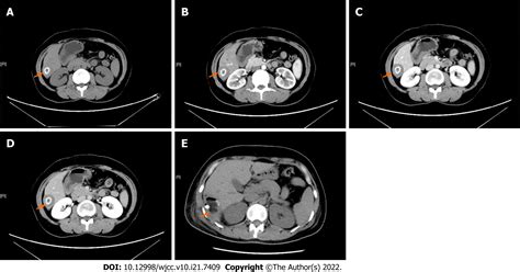 Liver Calcification X Ray At David Dolby Blog