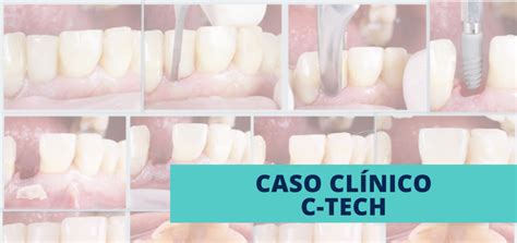 Colocación Inmediata De Implante Dental C Tech Dental Tonal