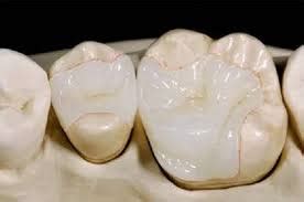 Porcelain Inlays Onlays Smile Creation Dental